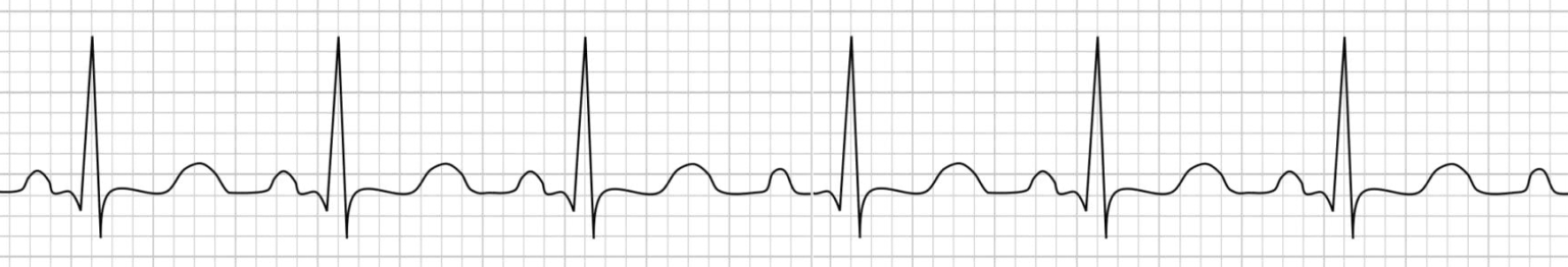 Hartfilmpje (ECG) – Huisartsenpraktijk Overcingel