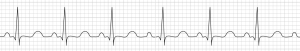 Hartfilmpje (ECG) – Huisartsenpraktijk Overcingel